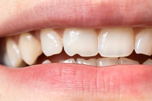 Fixing Translucent Looking Teeth - Cosmetic Dentist in Cary, NC
